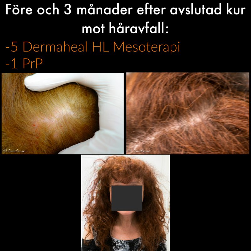 Mesoterapi mot håravfall - Zenidra.se